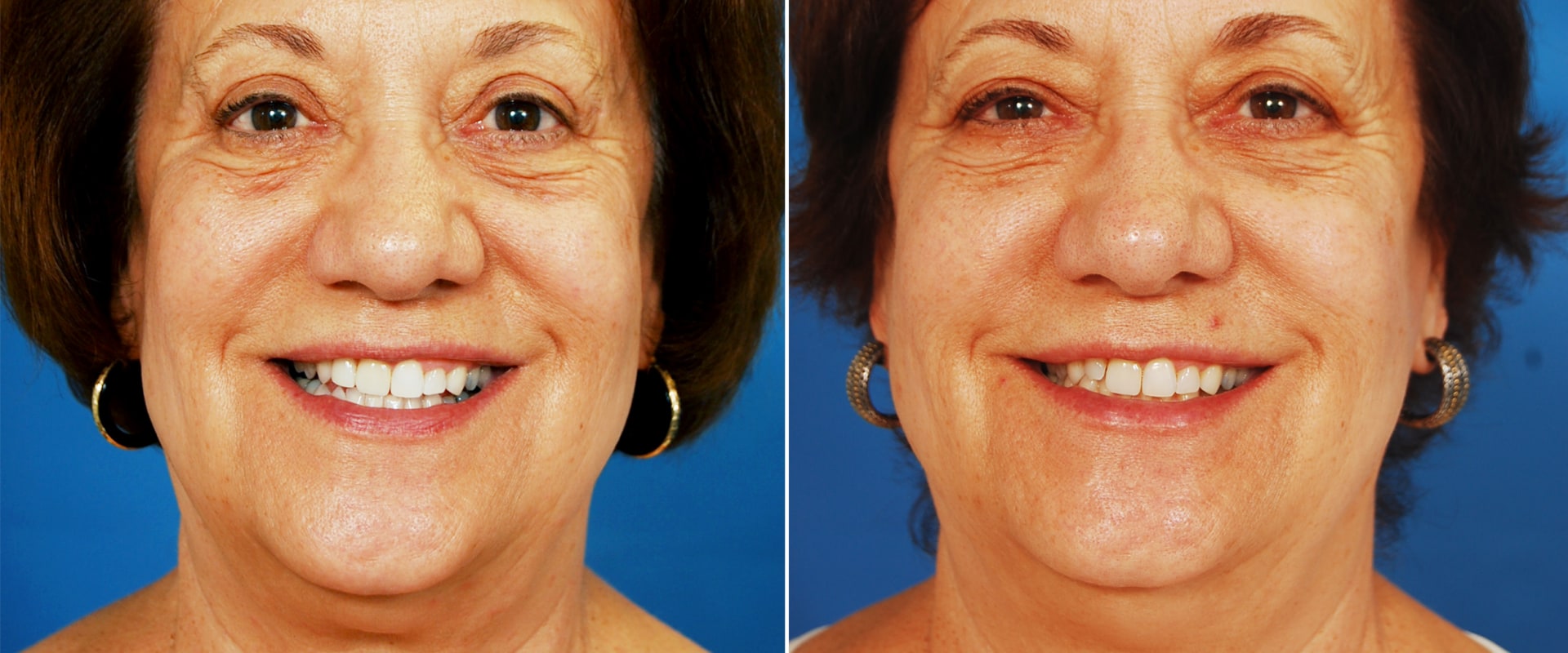 Cosmetic Surgery Beverly Hills CA