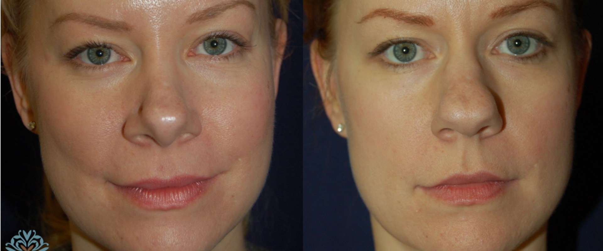 What are the different types of plastic surgery?